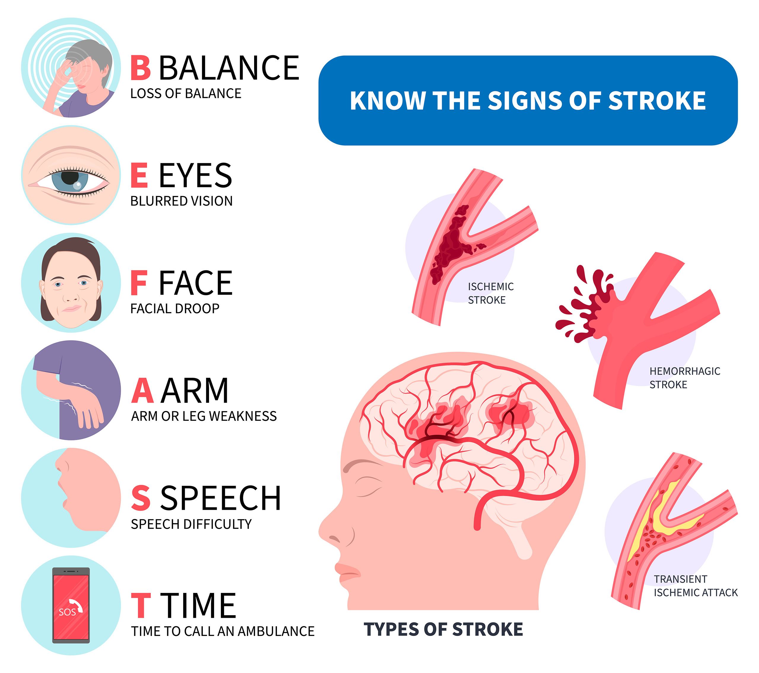 Time is brain when it comes to treating stroke